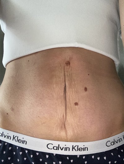 vertical stretch marks