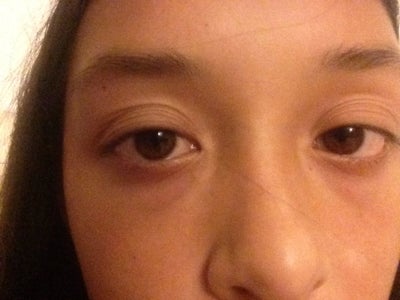 I have multiple eyelid creases, what can I do to get rid of them ...