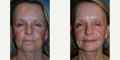 Laser Resurfacing Before & After Pictures - RealSelf