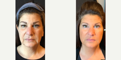 Thread Lift Before & After Pictures - RealSelf