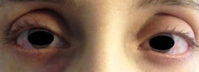 What can reduce the appearance of a negative vector eye & A-frame ...