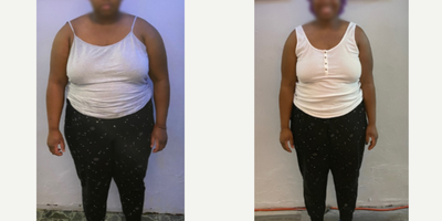 Semaglutide Before & After Pictures - RealSelf