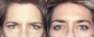 Brow Lift Before & After Pictures - RealSelf