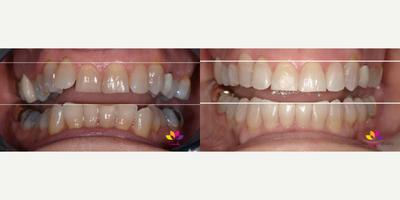 Invisalign Before & After Pictures - RealSelf