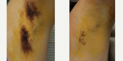 Botox Before & After Pictures - RealSelf