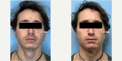 Dermal Fillers Before & After Pictures - RealSelf