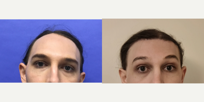 Forehead Reduction Before & After Pictures - RealSelf