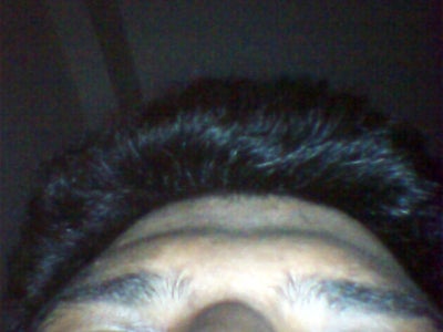 Swollen forehead or brow bone? (Photo) Doctor Answers, Tips