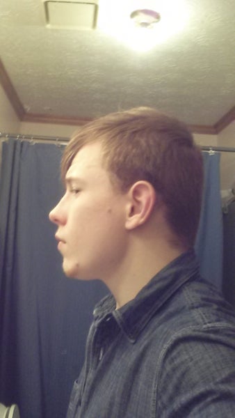 I have an overbite and a weak chin. As well as puffy cheeks. How do I ...