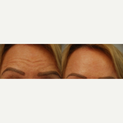 Botox Before & After Pictures - RealSelf