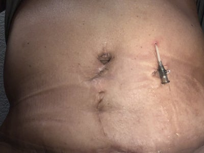 keyhole liposuction