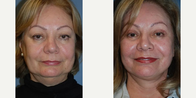 Cheek Lift Before & After Pictures - RealSelf