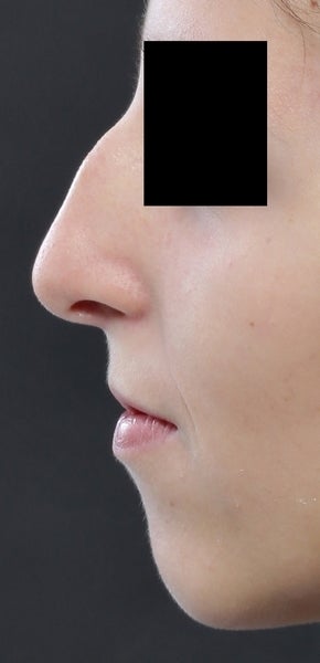 Nasal valve collapse on the right side of my nose? I can only breathe ...
