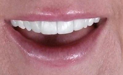 New Veneers (front four teeth) are causing me speech problems. Is it ...
