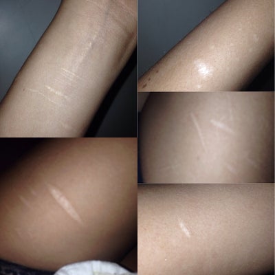 How can I get my large, flat, white scars removed? (Photo) Doctor ...