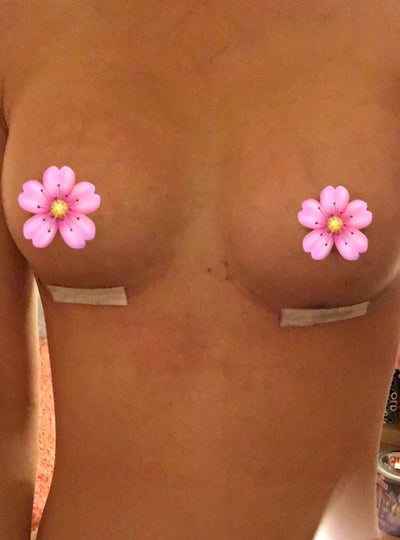 large breast implants realself