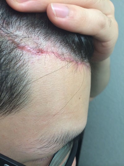 How do I deal with an ingrown hair at the incision site after hairline ...