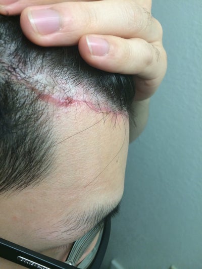 How do I deal with an ingrown hair at the incision site after hairline ...