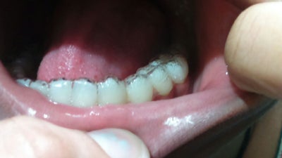 I've just started Invisalign, and my week 1 tray doesn't fit perfectly ...