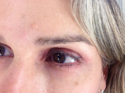 6 months post op upper bleph. left eye had inner corner webbing ...