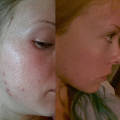 Ortho Tri Cyclen Lo Acne