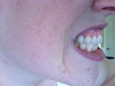 What is the Best Way to Treat my Gummy Smile? (photo) Doctor Answers, Tips
