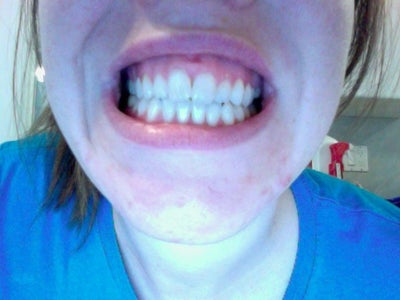 What is the Best Way to Treat my Gummy Smile? (photo) Doctor Answers, Tips