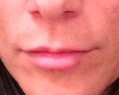 Best method to "curl up" upper lip? (Photo) Doctor Answers, Tips