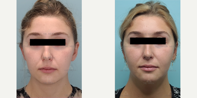 FaceTite Before & After Pictures - RealSelf