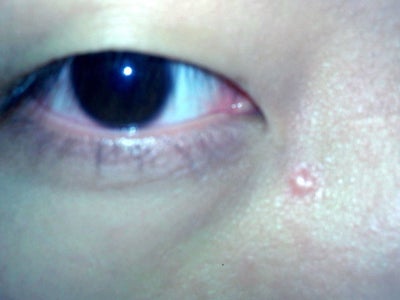 Ugly Hypertrophic Scar! - Laser Scar Removal forum