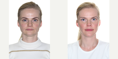 Jaw Surgery Before & After Pictures - RealSelf