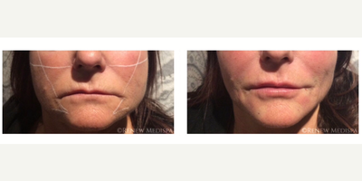 Bellafill Before & After Pictures - RealSelf