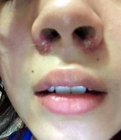 Is my alar base reduction healing properly or infected? (photos) Doctor ...