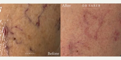 YAG Laser Before & After Pictures - RealSelf