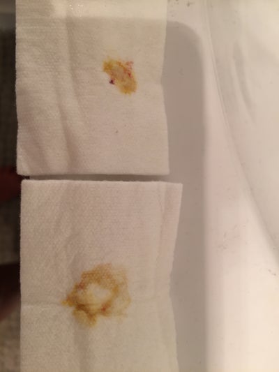 Will open wound, inverted T heal if spitting stitches are present ...