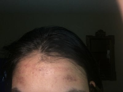 Are scabs and bruises normal after IPL? (Photo) Doctor Answers, Tips