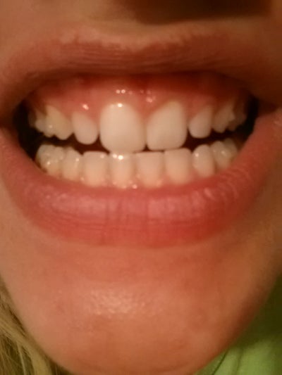 What Are Some Options for my Small Teeth? (photo) Doctor Answers, Tips