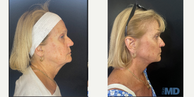 NeoGen Plasma Before & After Pictures - RealSelf
