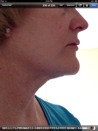 Bad Neck Liposuction/mini Facelift? (photo) Doctor Answers, Tips