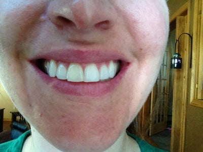 Bridge and porcelain crown on front four teeth or implant to replace ...