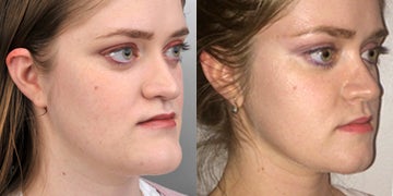 Pointy Chin Reduction