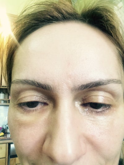 Swollen Eye Bag On One Side | IUCN Water