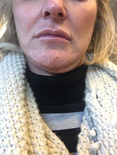 Do I have a cobra neck? And what can be done? (Photo) Doctor Answers, Tips