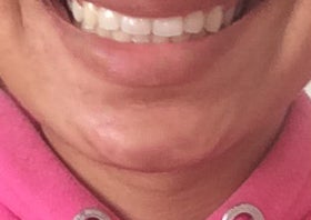 Why does my chin stick out like this? How can I fix it? (photos) Doctor ...