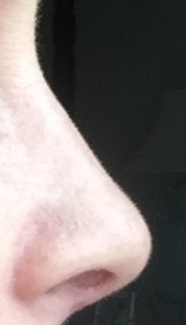 6 weeks post op: columella scar not great, hangs too much and white at ...