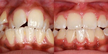 How Can I Fix my Big Front Teeth? Dentist Answers, Tips