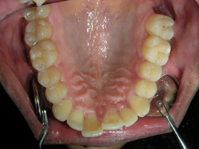 ceramic braces to correct overcrowding through tooth removal in 8mm ...