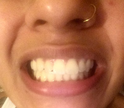 Can I fix my midline shift? (Photo) Dentist Answers, Tips