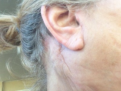 Swelling and hard lumps behind my ears and swelling and discoloration ...