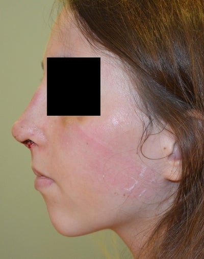 Nasal valve collapse on the right side of my nose? I can only breathe ...